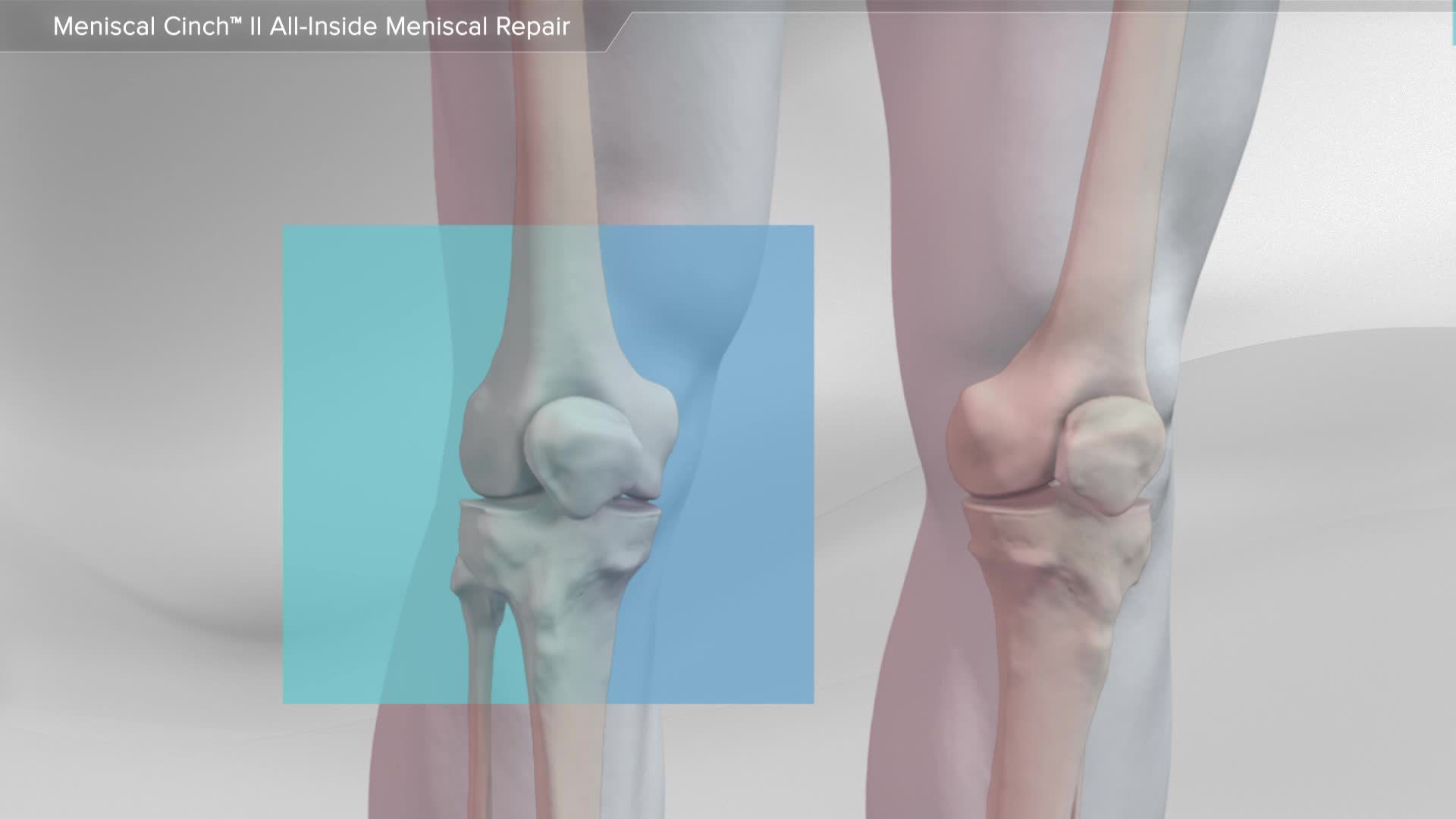 Meniscuschirugie (inklusive Meniscustransplantation) « Athlon Orthopedics